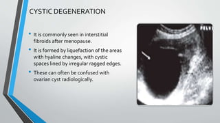 FIBROID%20UTERUS%20FINAL%20PPT copy.pptx