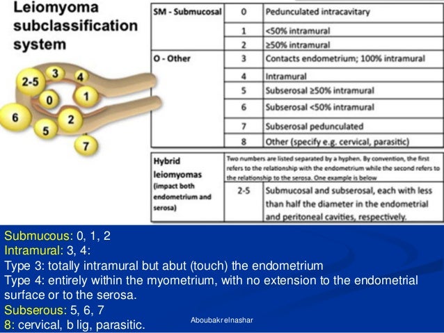 Intramural Fibroids Infertility