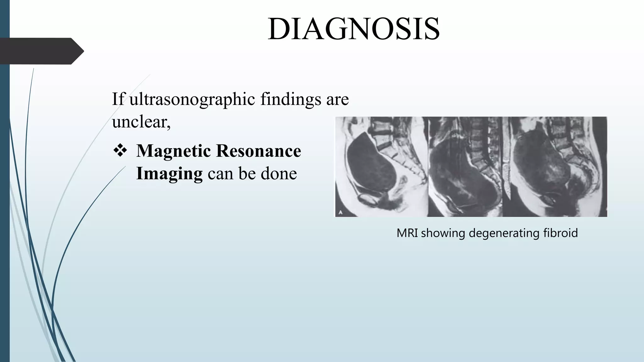 Fibroid complicating pregnancy | PPTX
