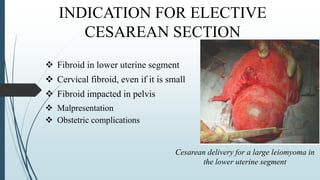 Fibroid complicating pregnancy | PPTX