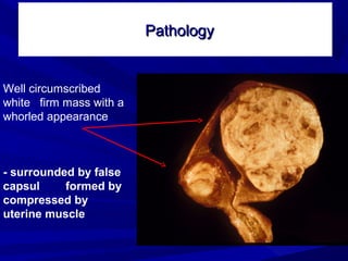 Fibroid for undergraduate | PPT