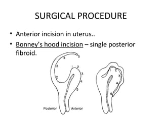 Management Of Fibroids | PPT