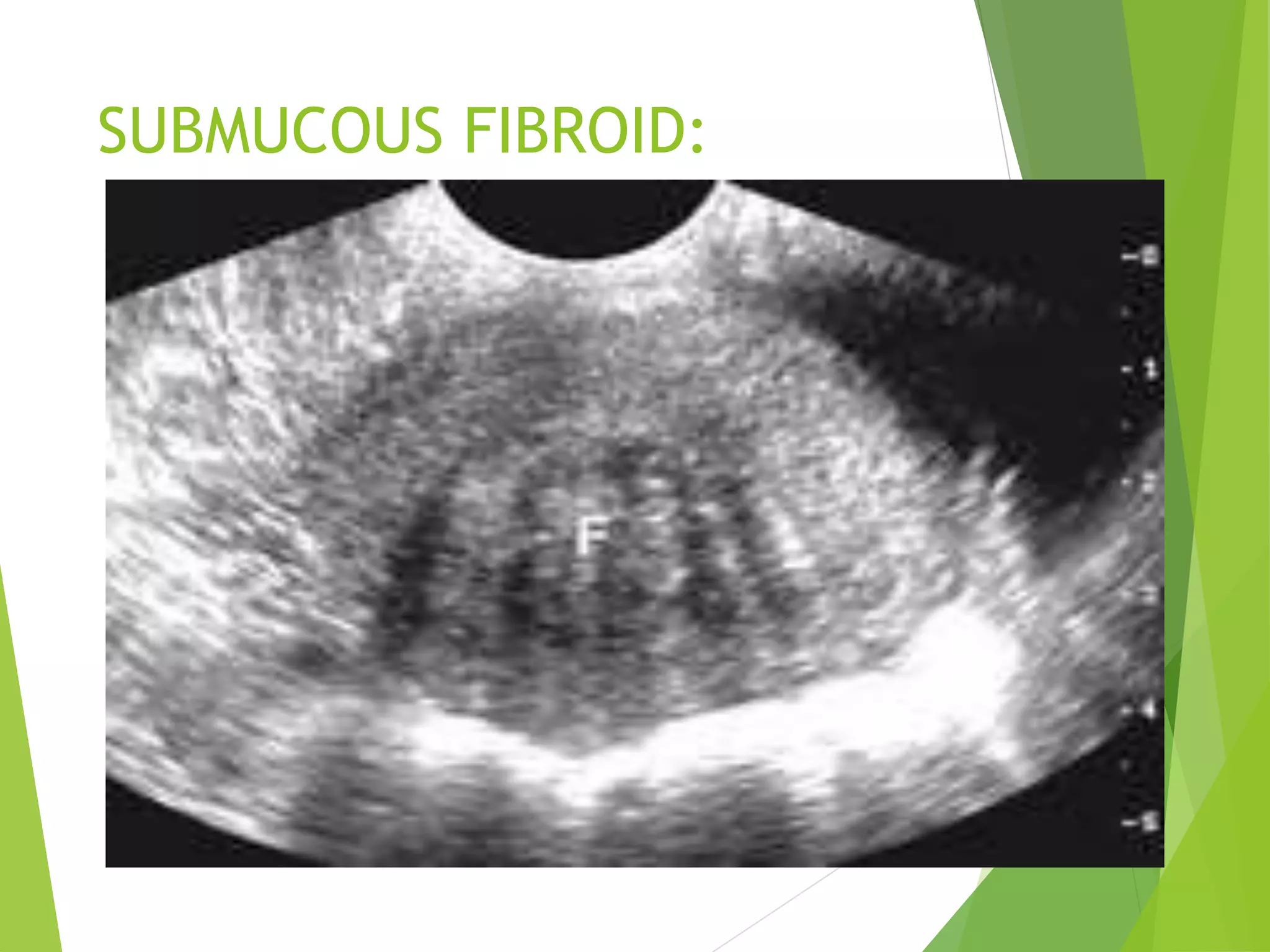fibroid presentation.ppt