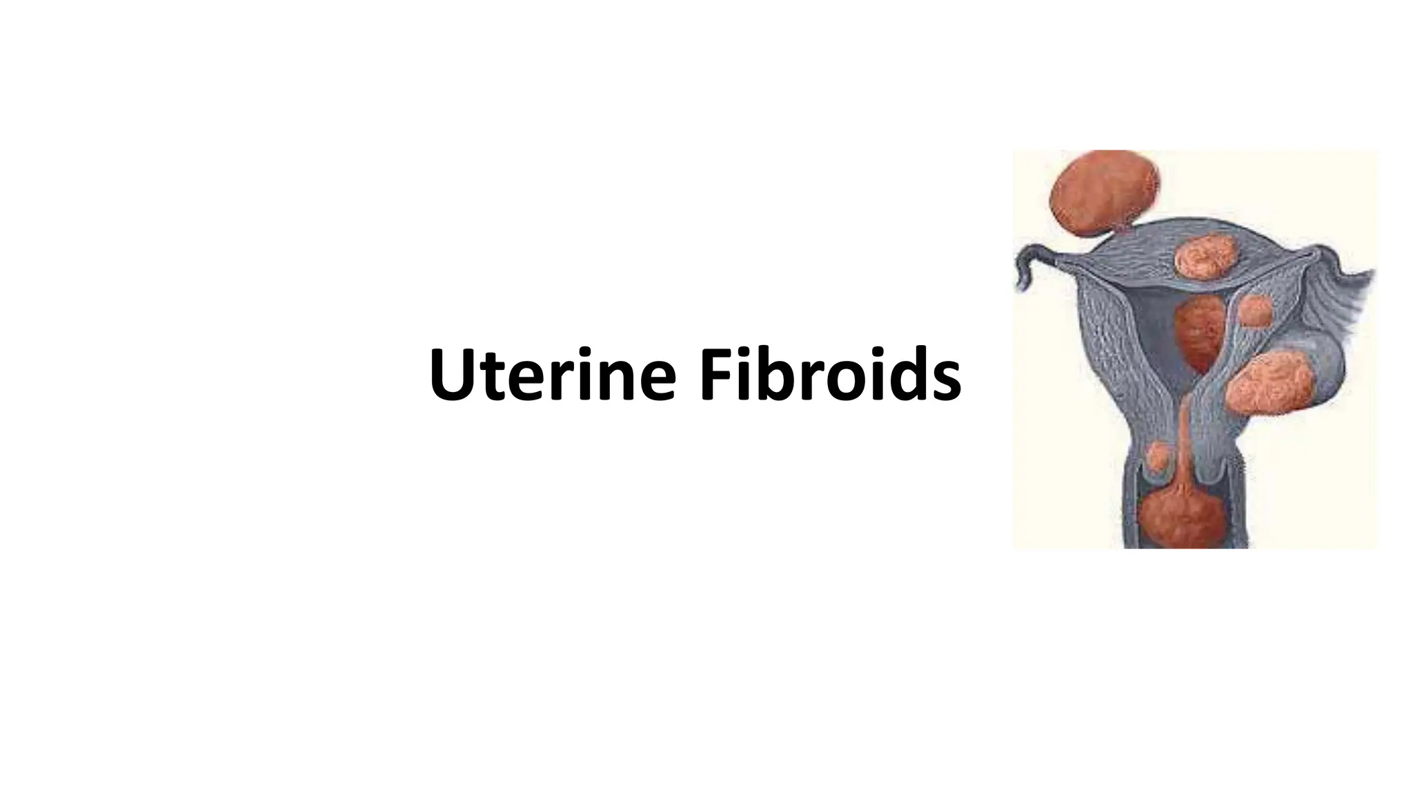 obstetrics Fibroid _ presentation . pptx | PPTX