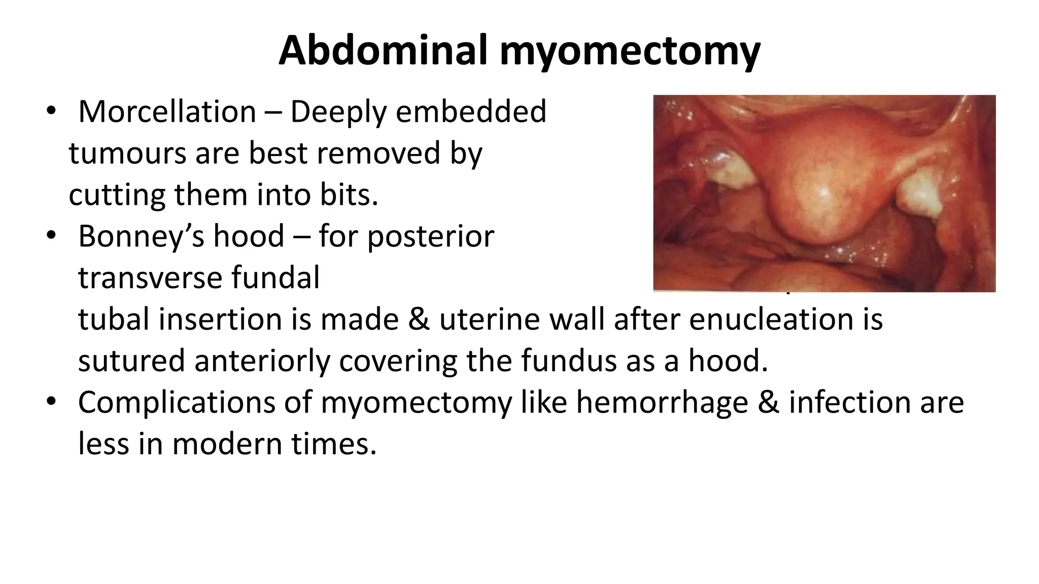 obstetrics Fibroid _ presentation . pptx | PPTX