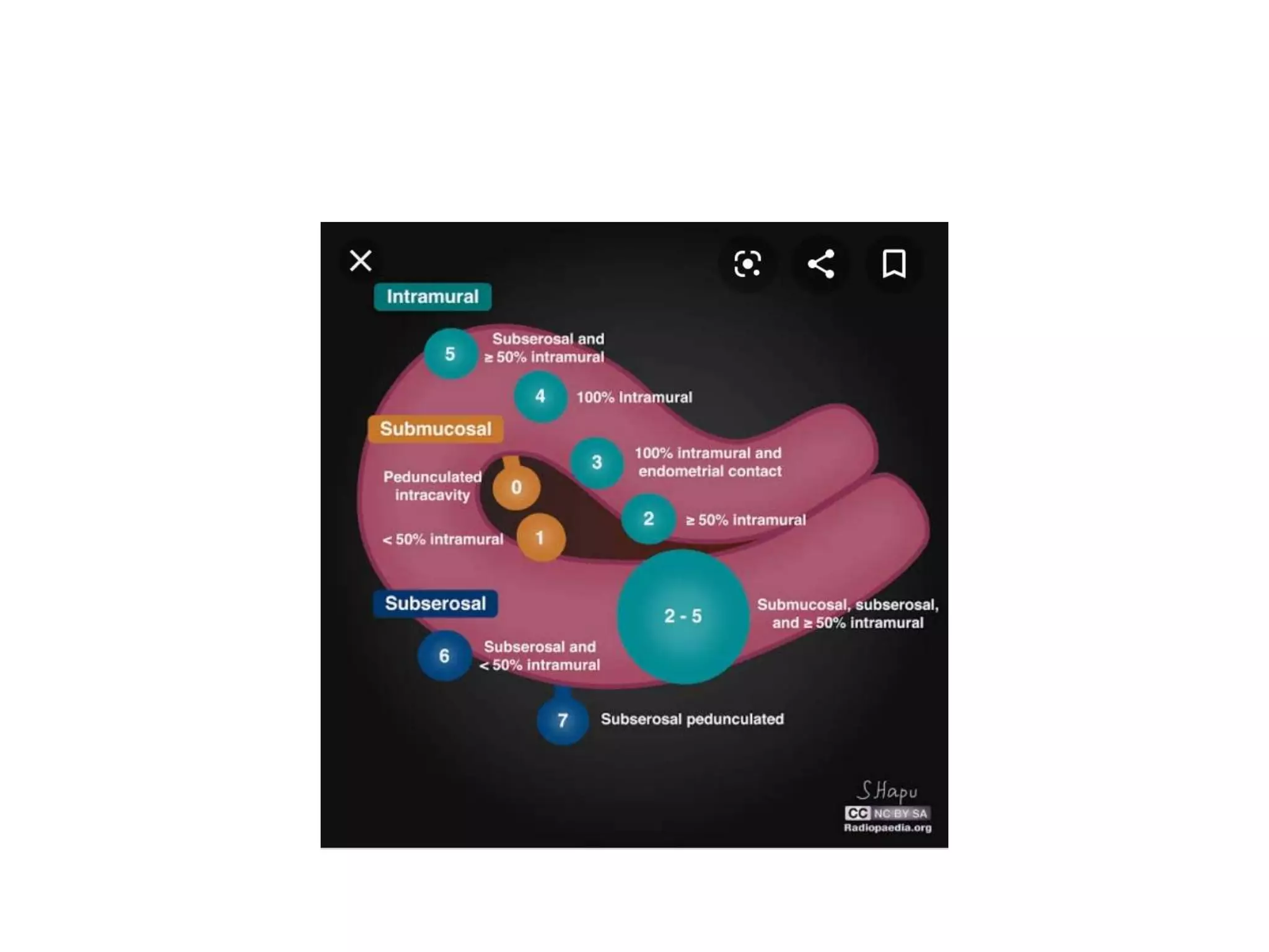 Fibroid presentation1 | PPT