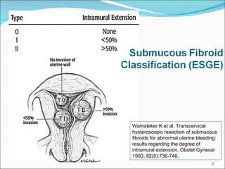 Fibroids | PPT