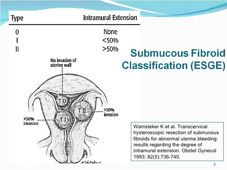 Fibroids