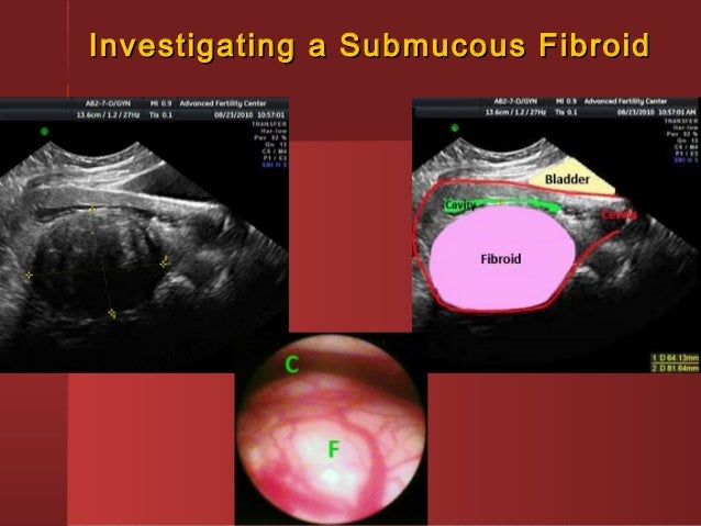 Fibroids