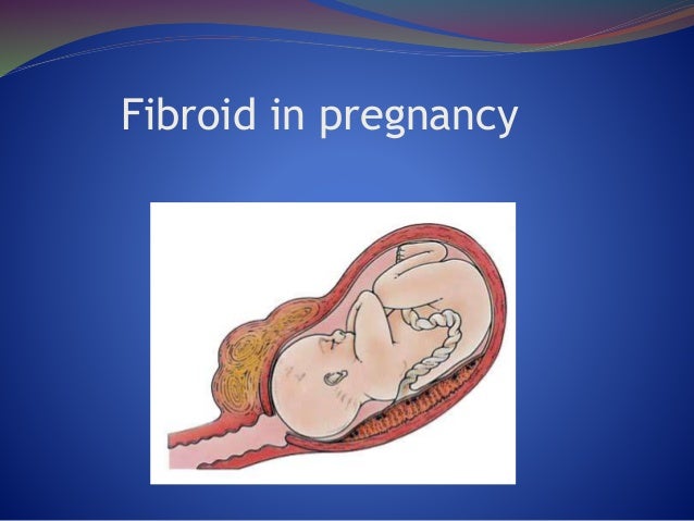 Fibroids