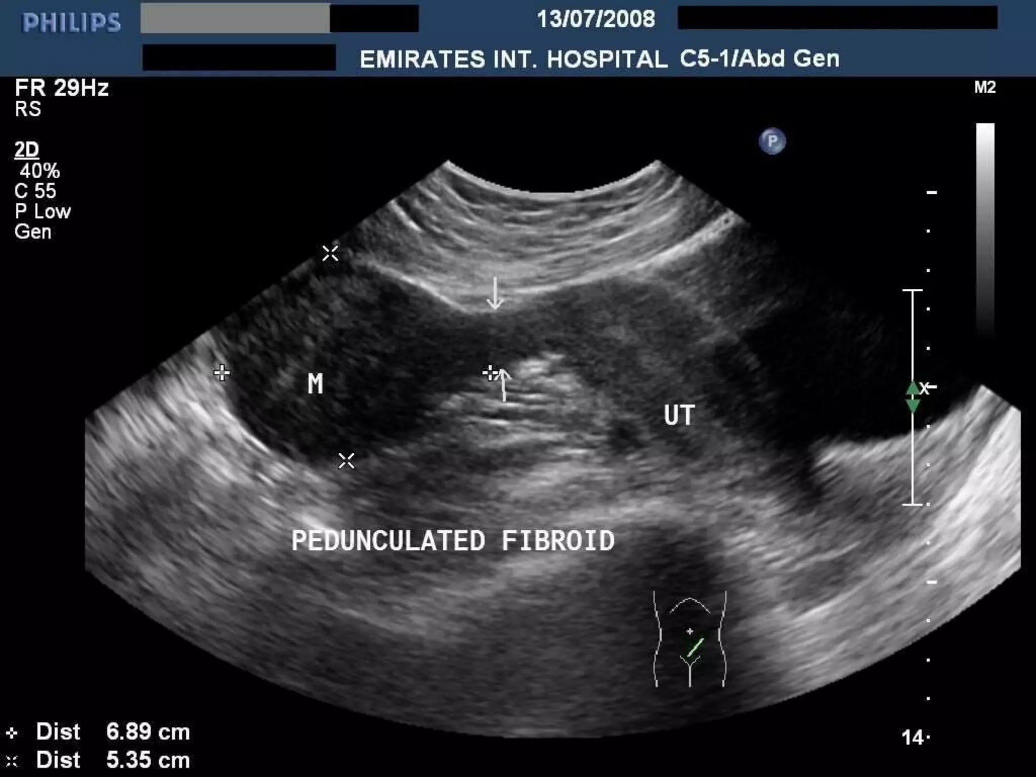 Uterine Fibroids on Ultrasound | PPTX