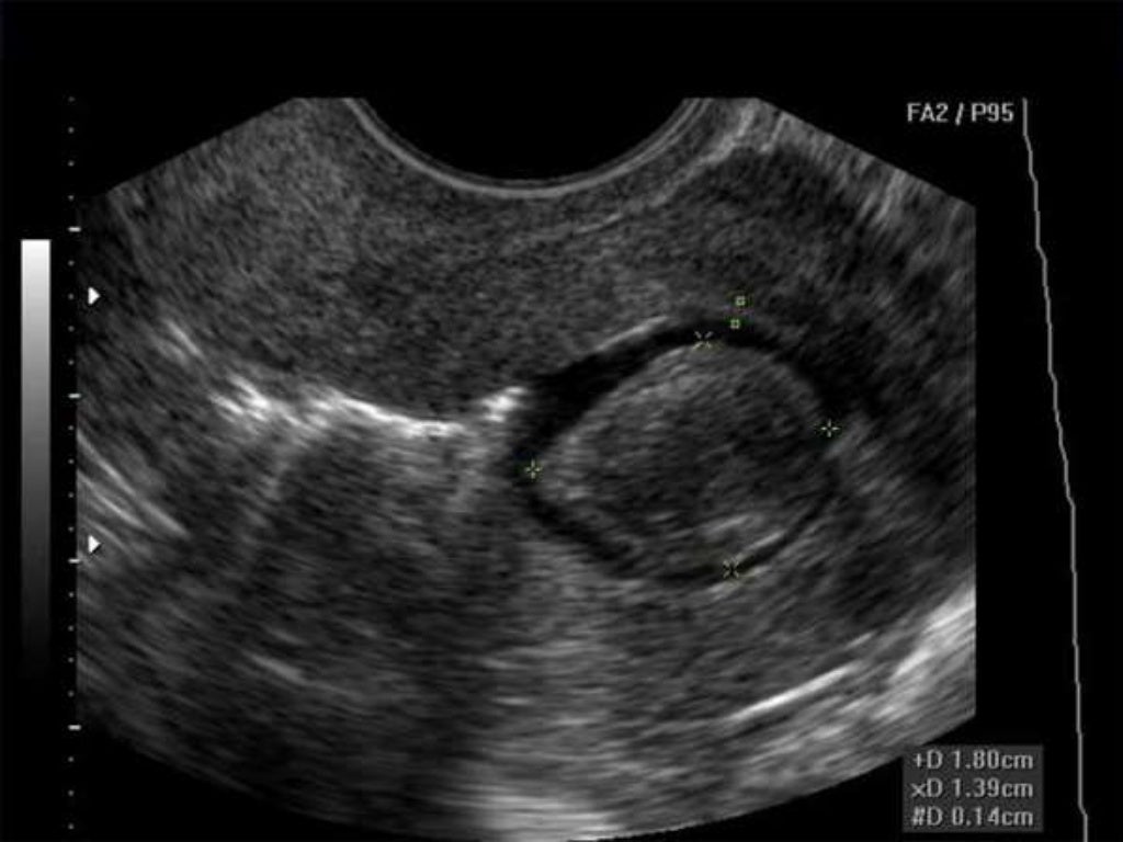Uterine Fibroids on Ultrasound