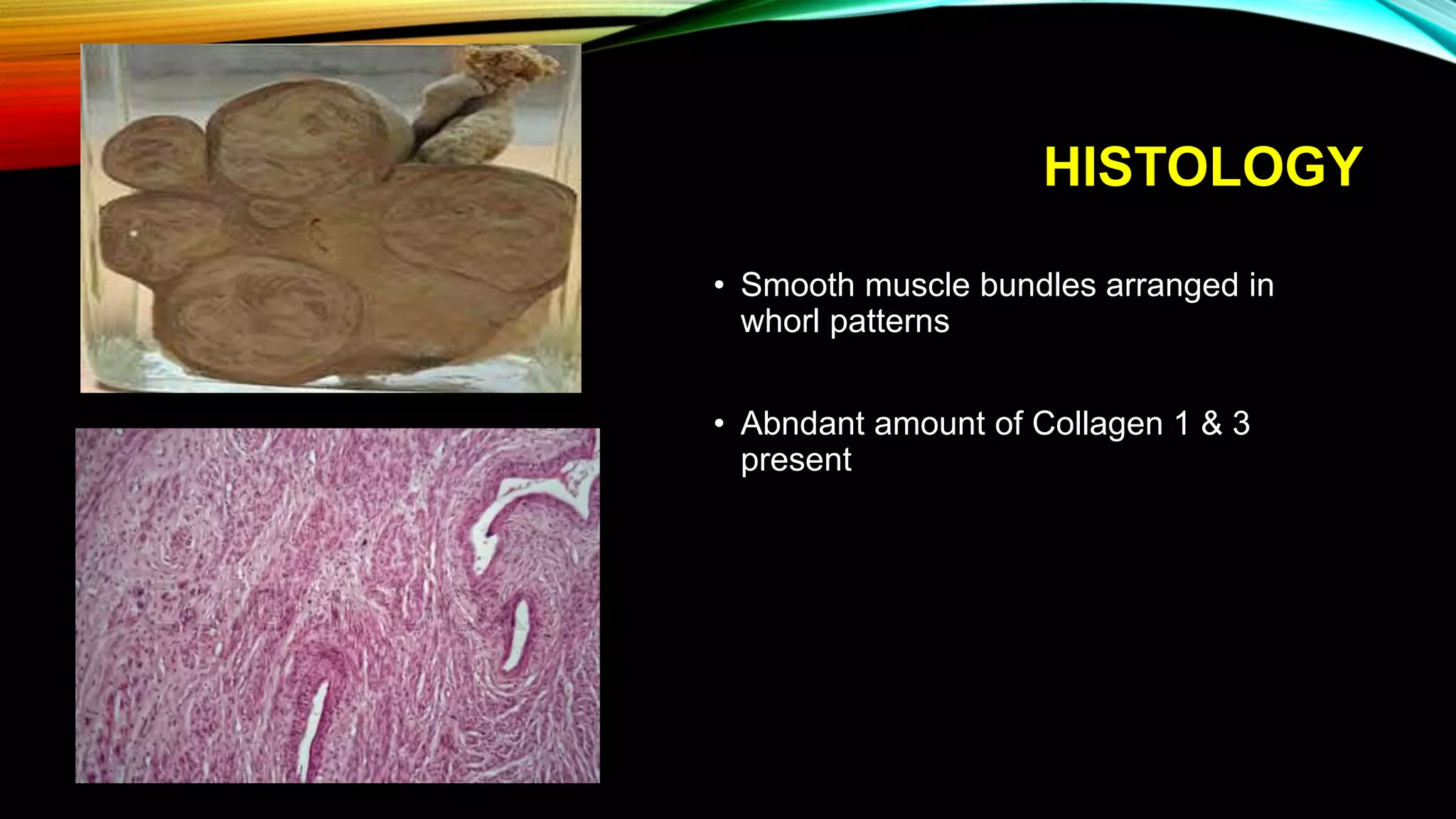 Fibroids | PPTX