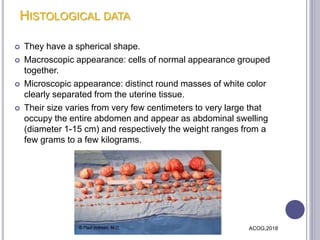 Uterine Fibroids | PPTX