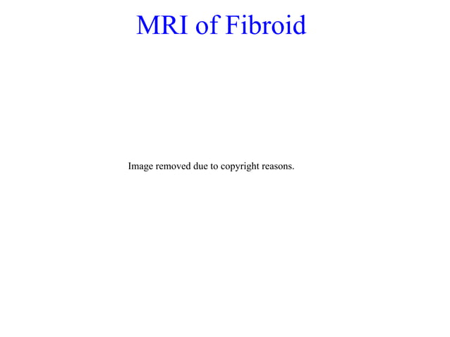 Fibroids | PPT