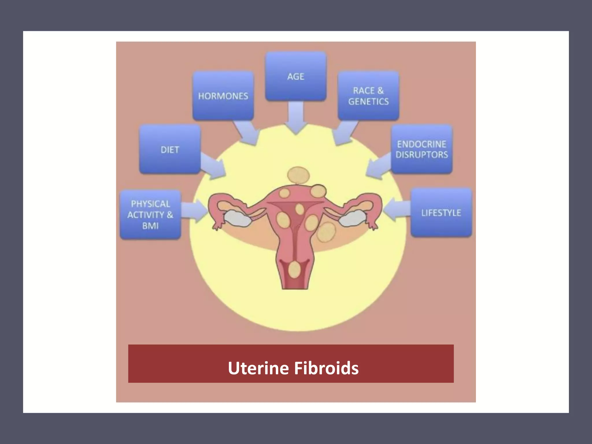 Uterine Fibroids (Leiomyomata): Investigations and Treatment | PDF