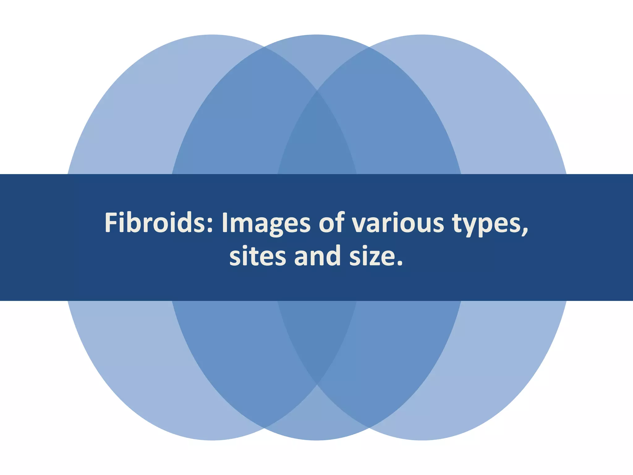 Uterine Fibroids (Leiomyomata): Investigations and Treatment | PDF