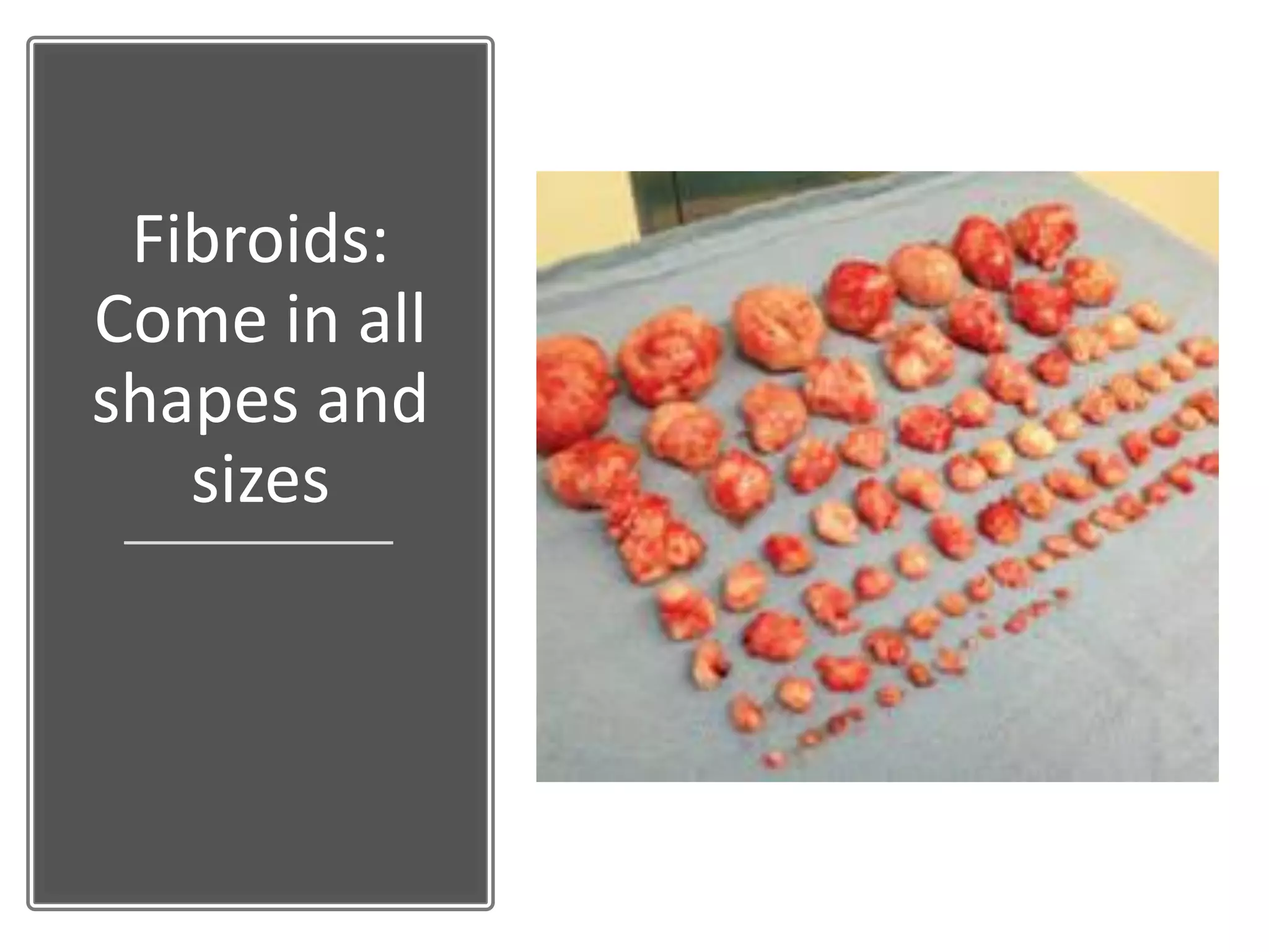 Uterine Fibroids (Leiomyomata): Investigations and Treatment | PDF