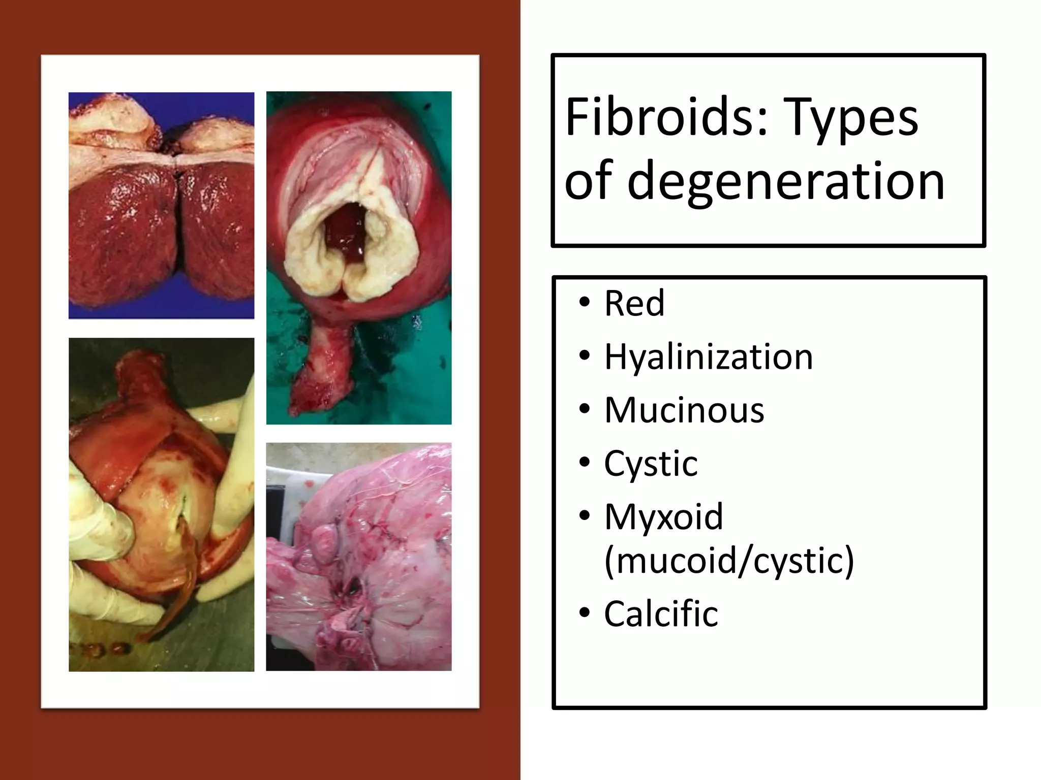 Uterine Fibroids (Leiomyomata): Investigations and Treatment | PDF
