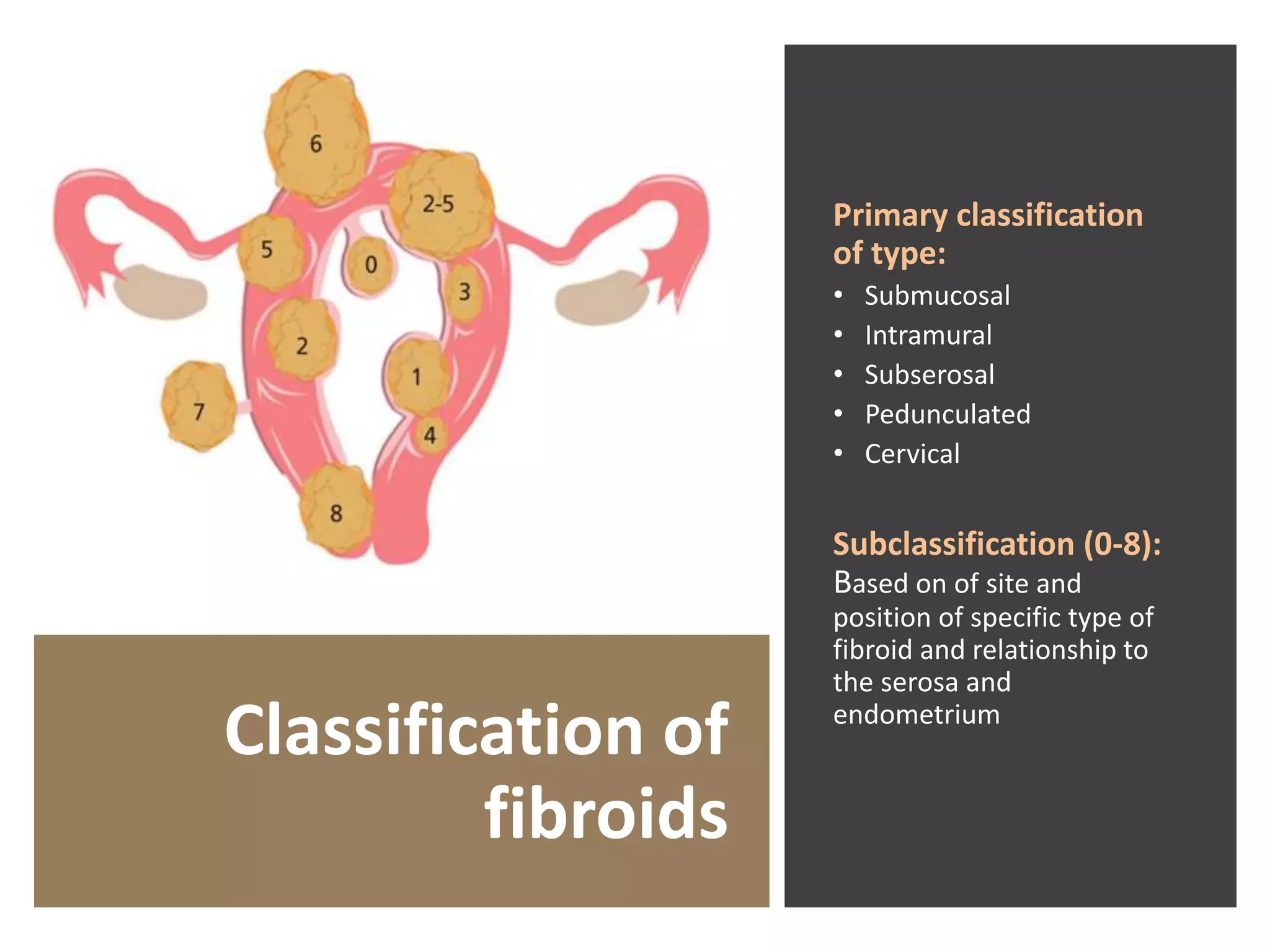 Uterine Fibroids (Leiomyomata): Investigations and Treatment | PDF