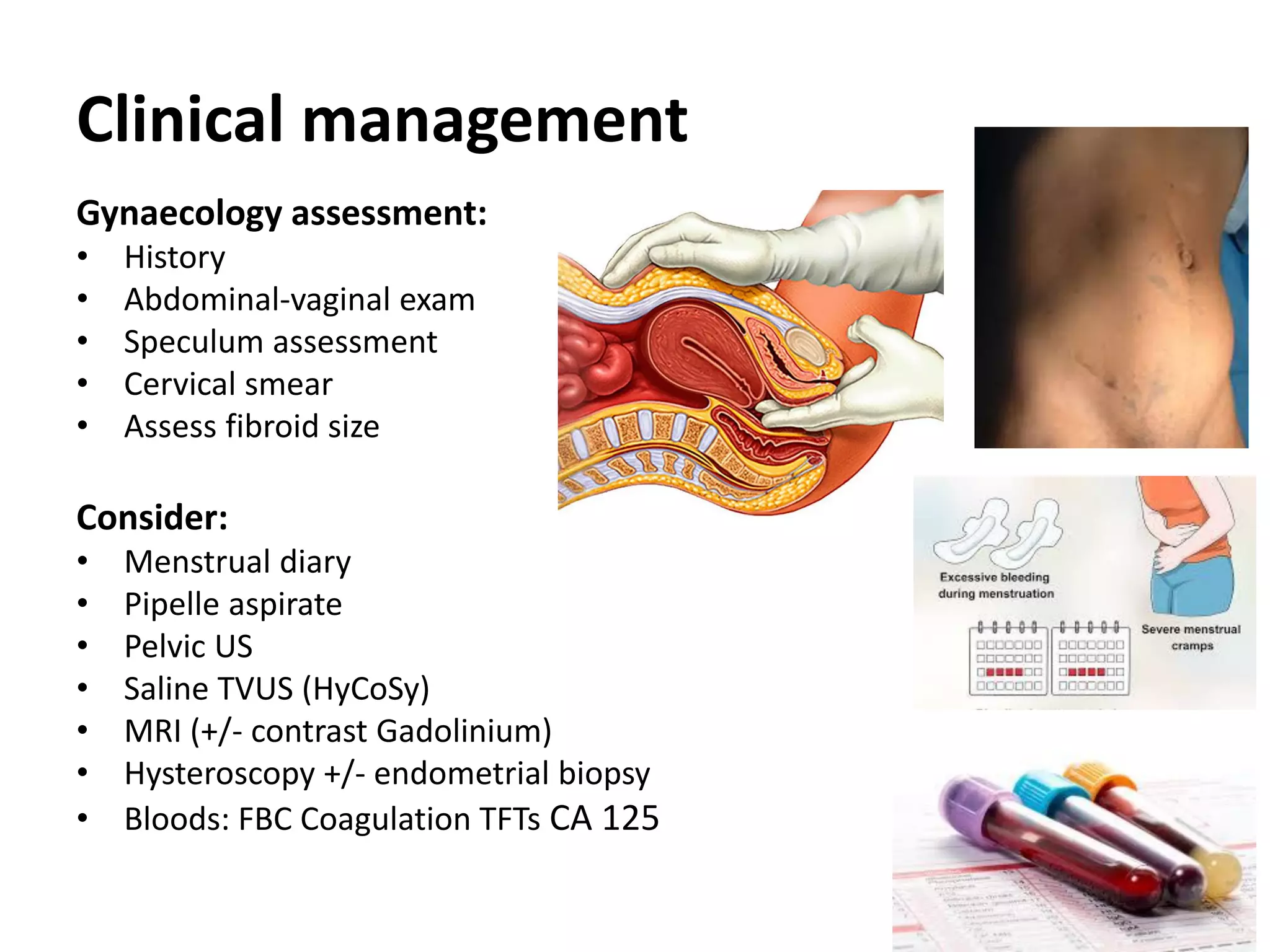 Uterine Fibroids (Leiomyomata): Investigations and Treatment | PDF
