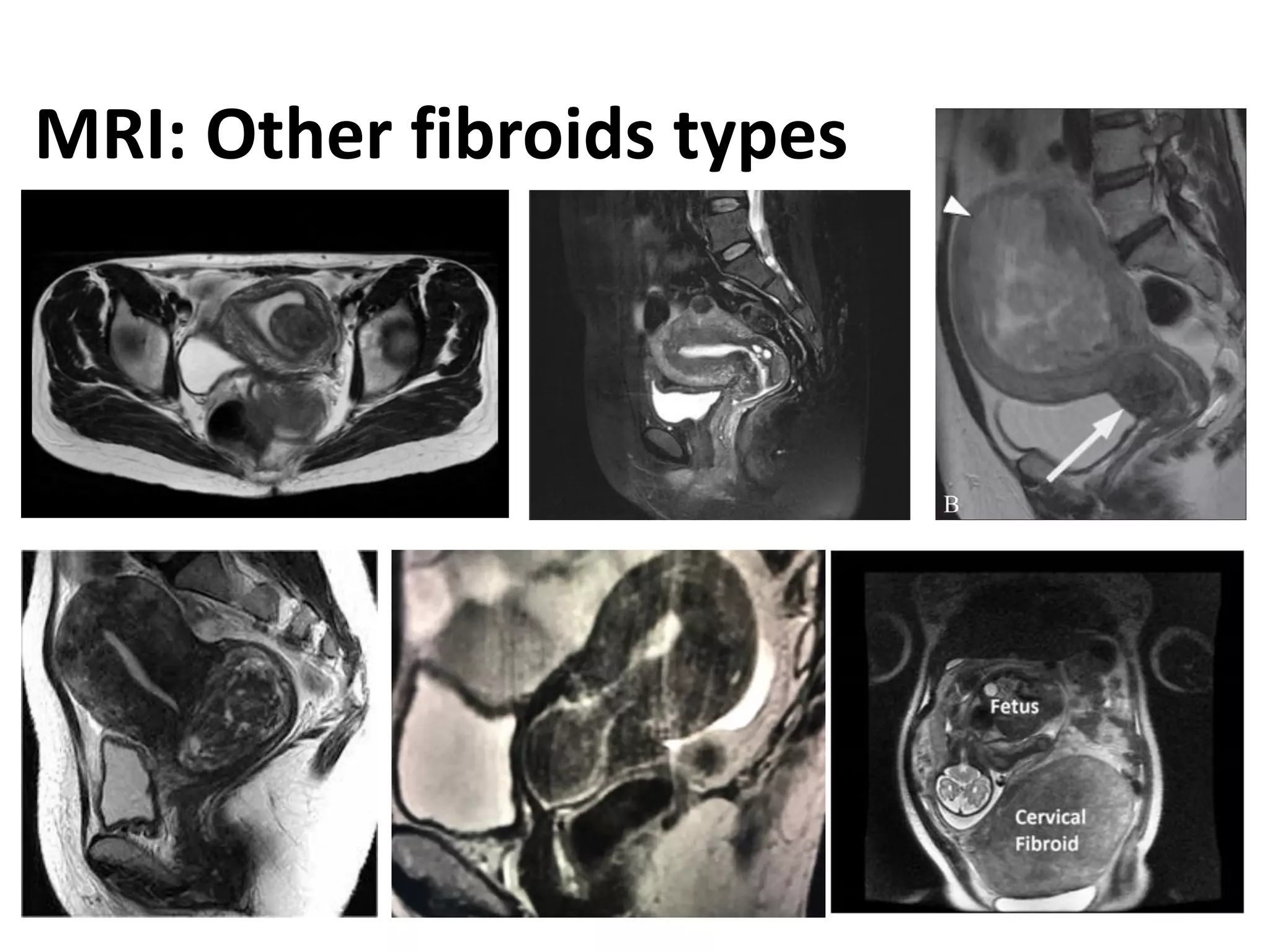Uterine Fibroids (Leiomyomata): Investigations and Treatment | PDF