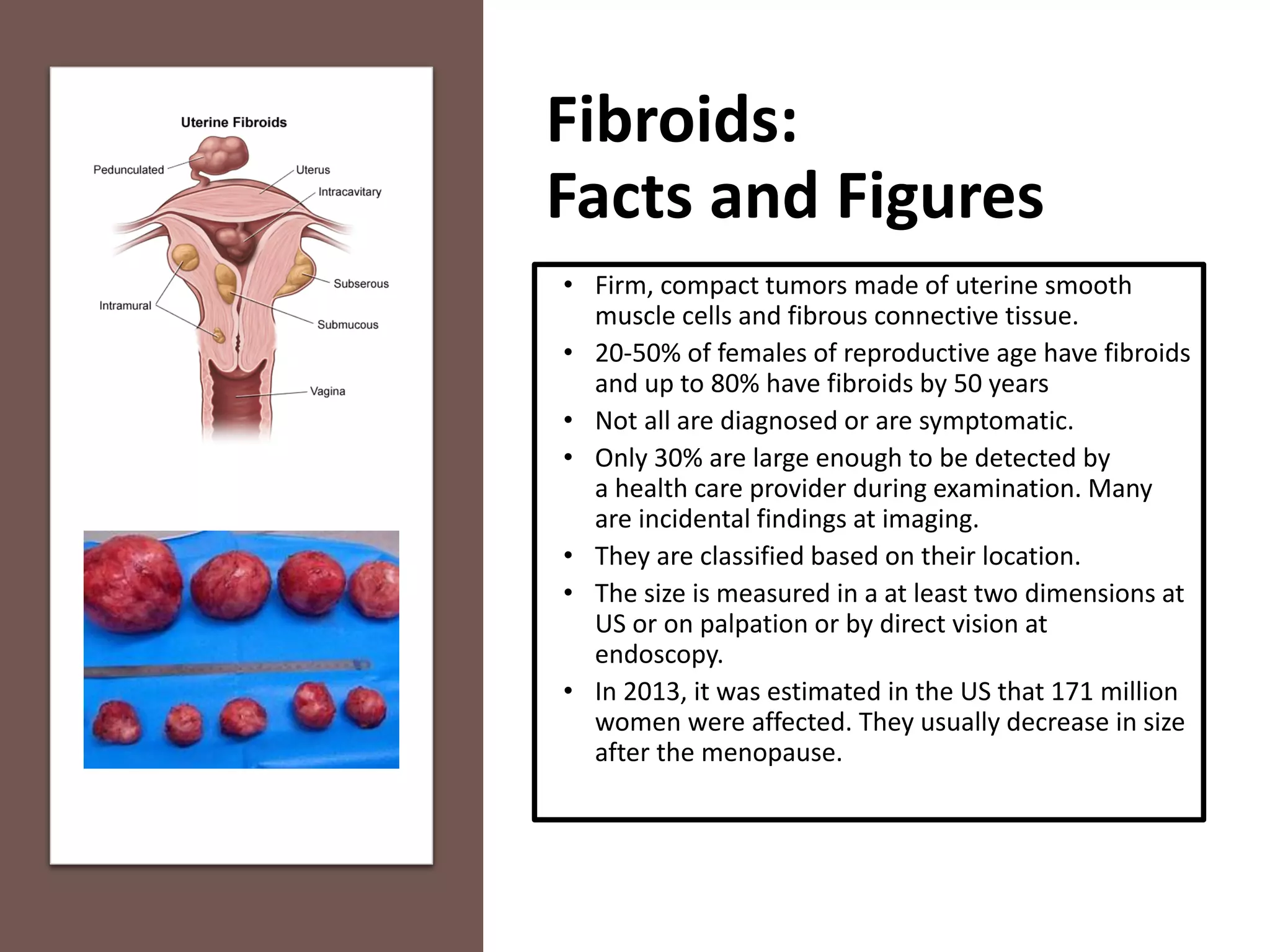 Uterine Fibroids (Leiomyomata): Investigations and Treatment | PDF