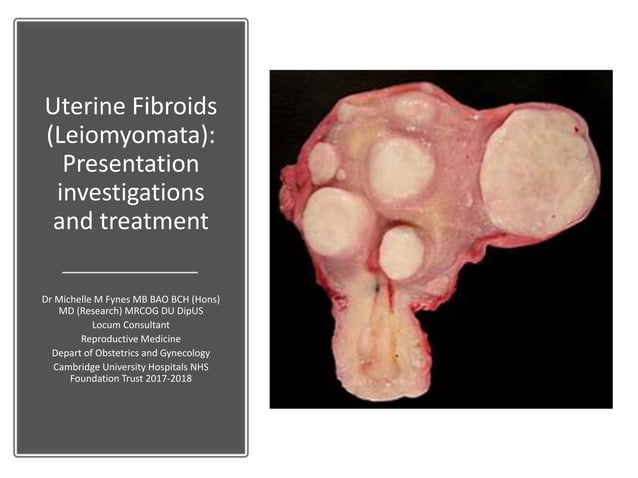 Uterine Fibroids (Leiomyomata): Investigations and Treatment | PDF