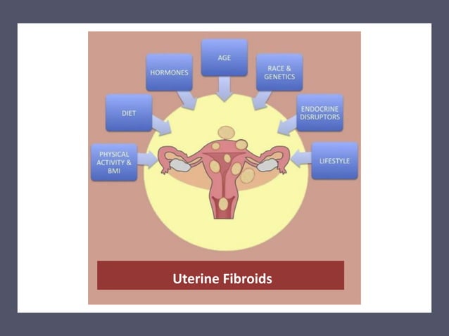Uterine Fibroids (Leiomyomata): Investigations and Treatment | PDF