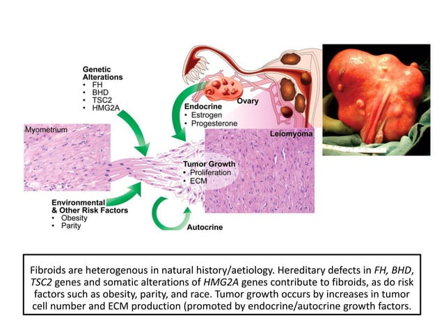 Uterine Fibroids (Leiomyomata): Investigations and Treatment | PDF