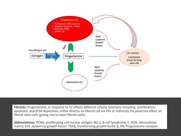 Uterine Fibroids (Leiomyomata): Investigations and Treatment | PDF