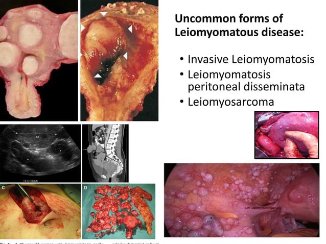 Uterine Fibroids (Leiomyomata): Investigations and Treatment | PDF