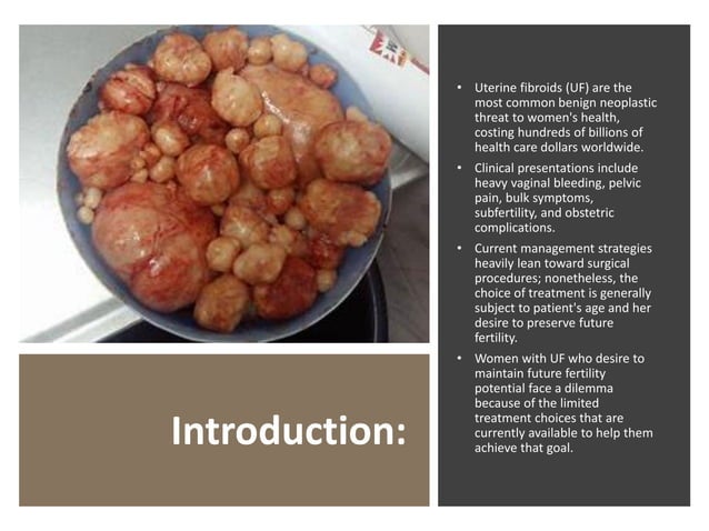 Uterine Fibroids (Leiomyomata): Investigations and Treatment | PDF