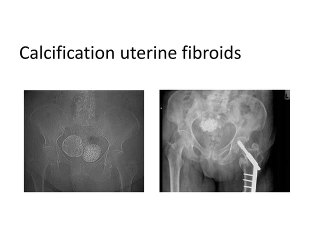Uterine Fibroids (Leiomyomata): Investigations and Treatment | PDF