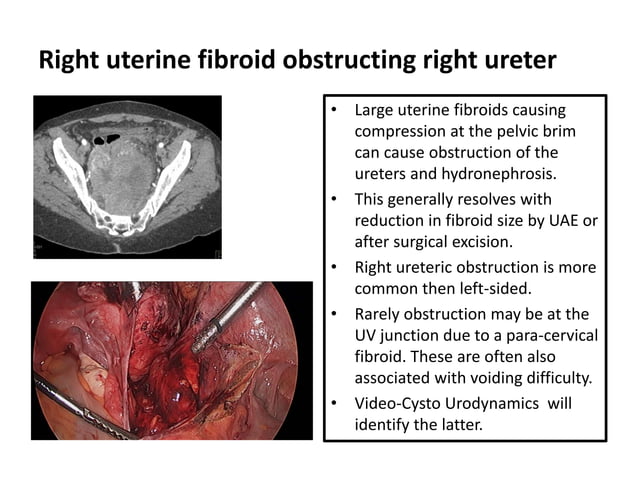 Uterine Fibroids (Leiomyomata): Investigations and Treatment | PDF