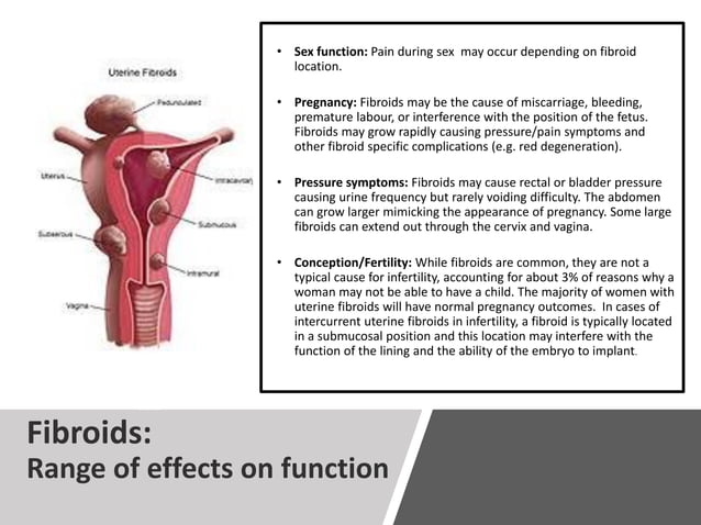 Uterine Fibroids (Leiomyomata): Investigations and Treatment | PDF