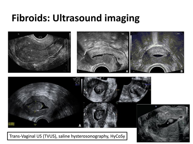 Uterine Fibroids (Leiomyomata): Investigations and Treatment | PDF