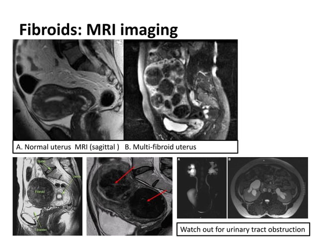 Uterine Fibroids (Leiomyomata): Investigations and Treatment | PDF