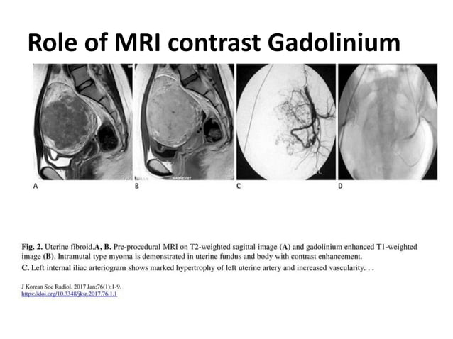 Uterine Fibroids (Leiomyomata): Investigations and Treatment | PDF