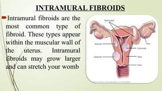 fibroidsppt-uterine fibroids, are a common and significant concern in ...