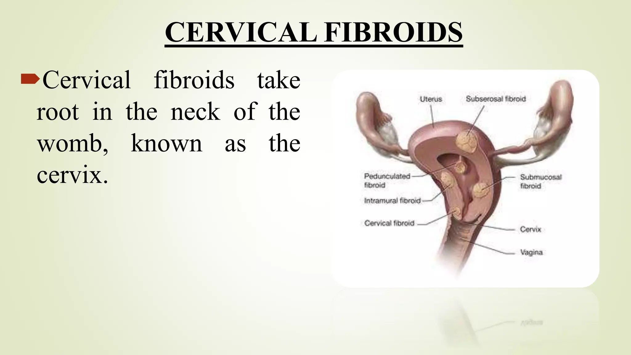 FIBROIDS PPT.pptx