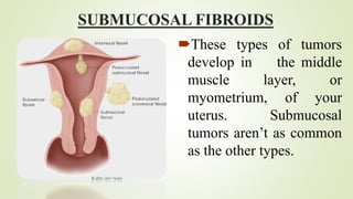 FIBROIDS PPT.pptx