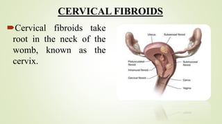 FIBROIDS PPT.pptx
