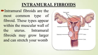 FIBROIDS PPT.pptx