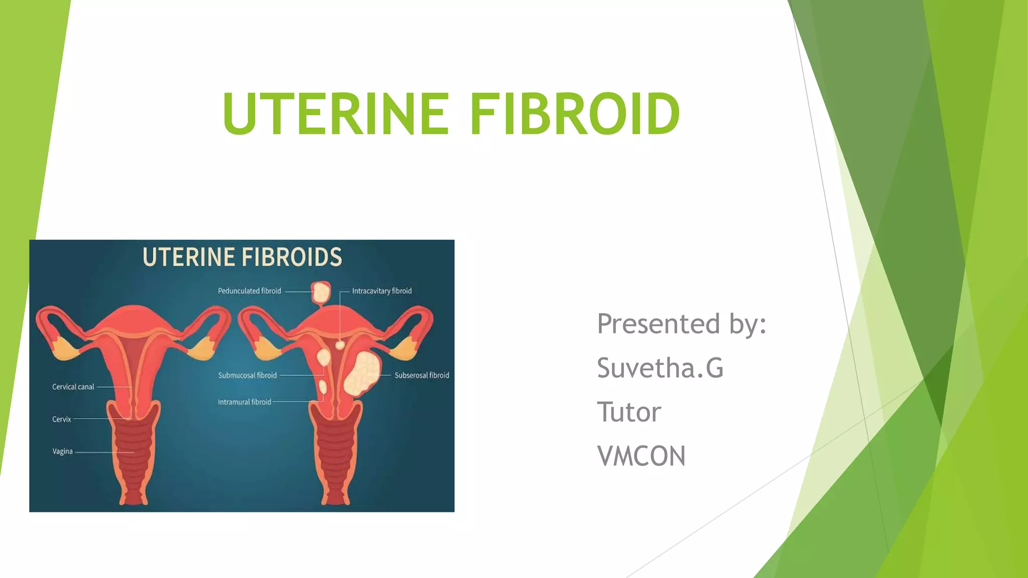fibroids uterus.pptx