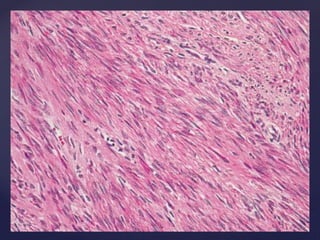 Submucosal Fibroids And Heavy Bleeding