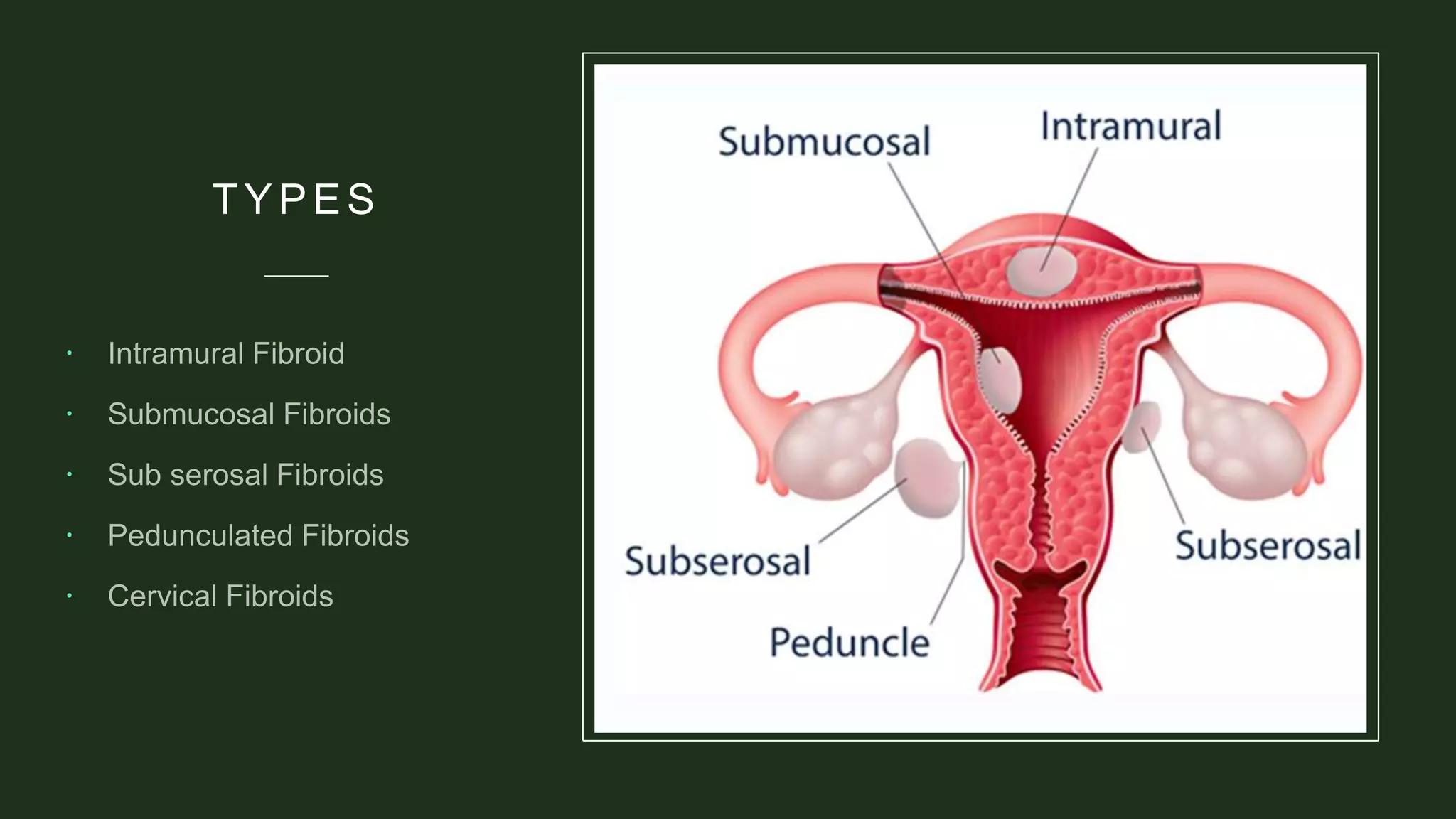 Fibroid Uterus.pptx