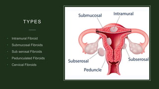 Fibroid Uterus.pptx