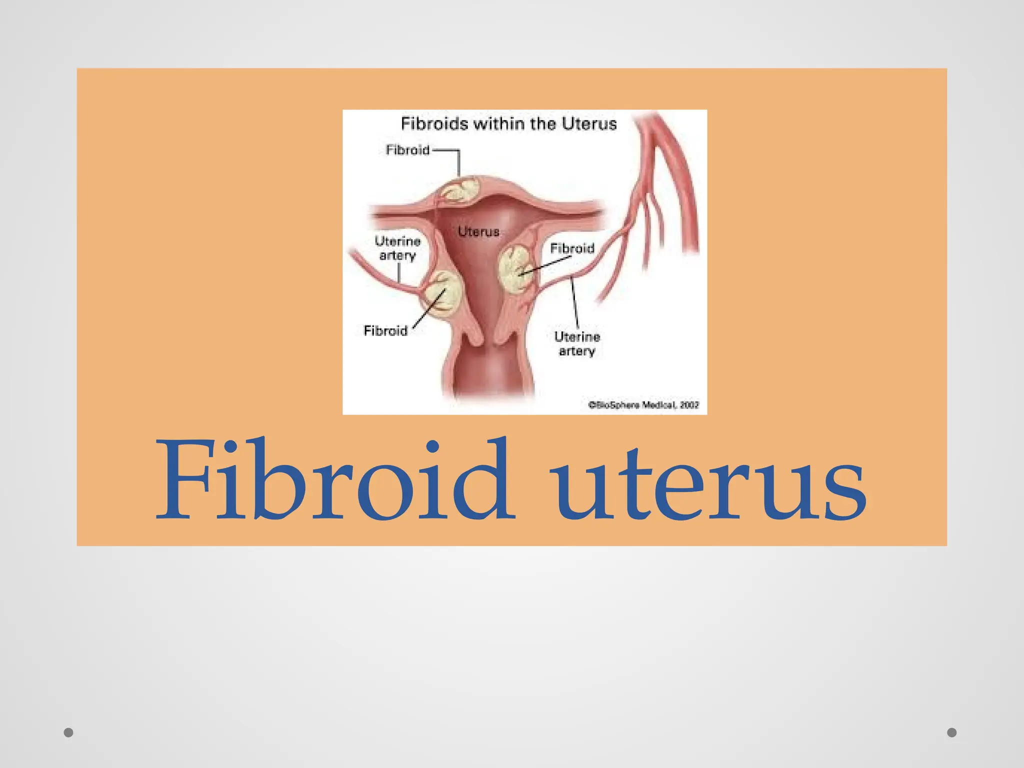 Fibroid uterus incluiding symptoms, diagnosis and treatment | PPTX