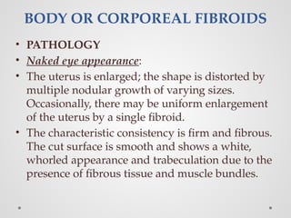 Fibroid uterus incluiding symptoms, diagnosis and treatment | PPTX